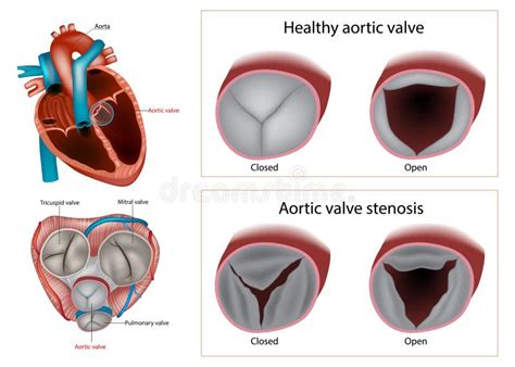 Healthy Aortic Valve Or Aortic Valve Stenosis Type Of Heart Valve Disease Or Valvular Heart