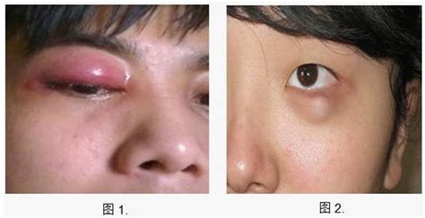 皮下囊肿的症状图片有来医生