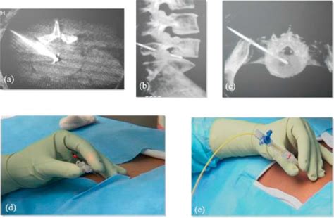Radiofrequency Ablation For Herniated Disc Is It Effective