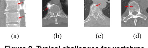 Figure 1 From 3d Vertebrae Segmentation In Ct Images With Random Noises Semantic Scholar