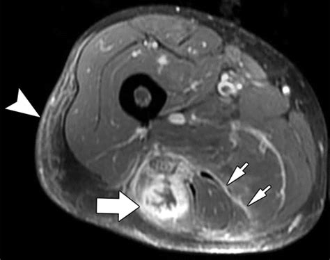 Soft Tissue Infections And Their Imaging Mimics From Cellulitis To