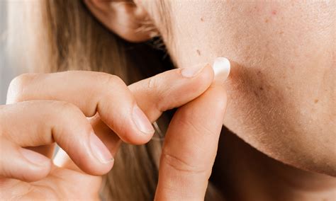 The Common Pimple Patch Mistake Youre Probably Making