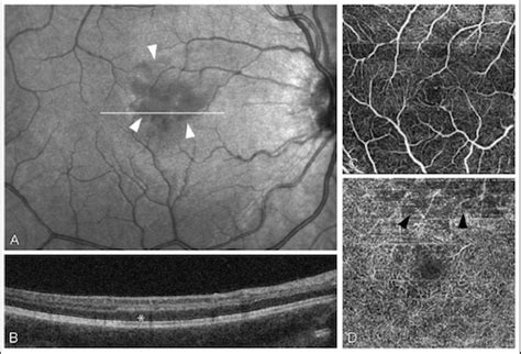 Artigo Pamm E Amn Retina Grand Rounds