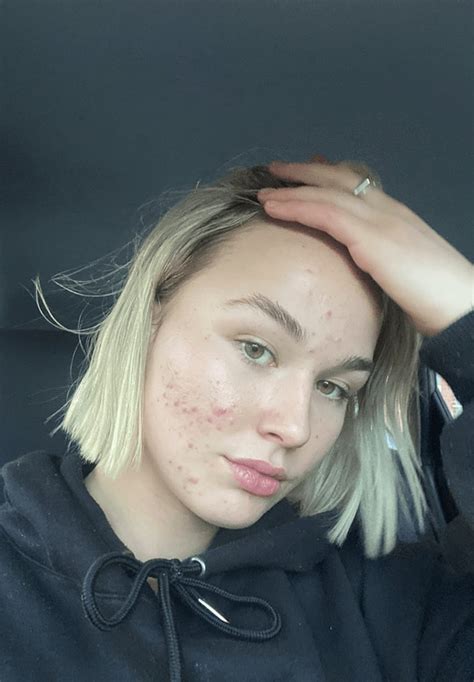 I Asked An Expert What To Do About My Impaired Skin Barrier