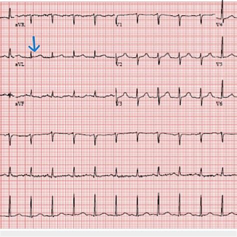 Ekg Showing Complete Resolution Of St Segment Elevation In Lateral