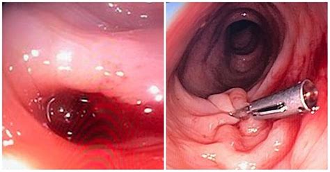 Image Diverticulum With Bleeding دليل Msd الإرشادي إصدار المُستخدِم