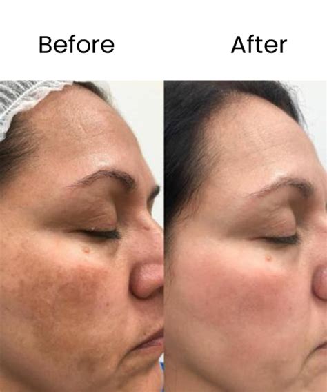 Face Prp Treatment Before After 3d Lifestyle Pk 3d Lifestyle Pk