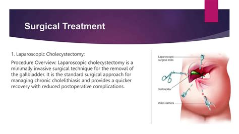 Post Cholecystectomy Syndrome And Chronic Cholelithiasispptx