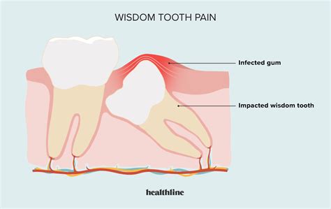 Wisdom Tooth Pain Relief Treatment And More