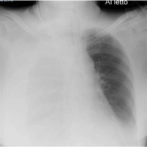 Hemothorax On Chest X Ray Download Scientific Diagram