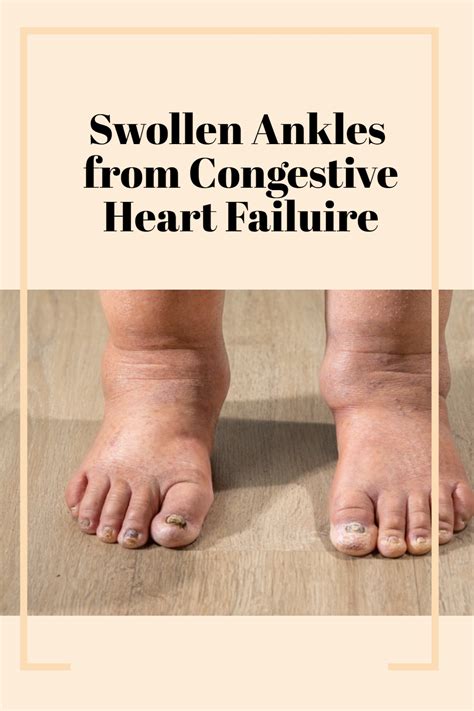 Pictures Of Swollen Ankles Due To Congestive Heart Failure Artofit