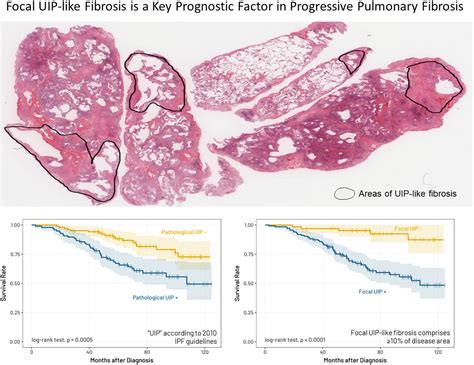 Presence Of Focal Usual Interstitial Pneumonia Is A Key Prognostic
