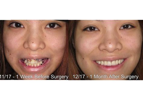 Young Patients Smile Restored With All On 4 Advanced Periodontics