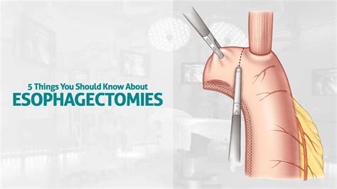 Esophagectomy Everything You Need To Know Iksoy