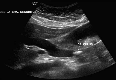 An Obstructive Calculus In The Common Bile Duct Sonohive
