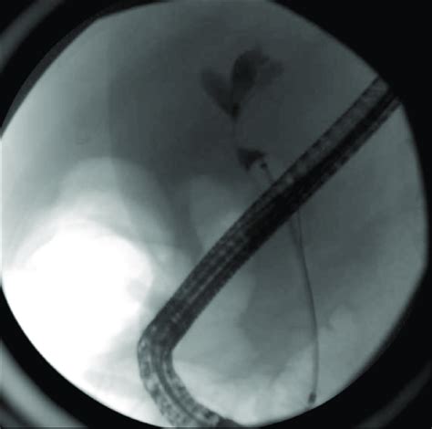 Cholangiogram Showing A Stricture At The Level Of Hepatic Bifurcation Download Scientific