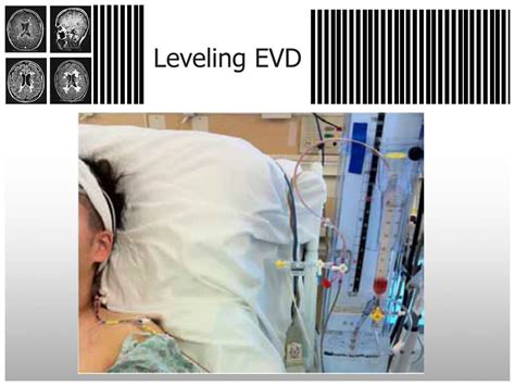 Ppt Care Of The Patient With An Evd Or Lumbar Drain Powerpoint