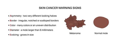 Premium Vector Melanoma Warning Signs