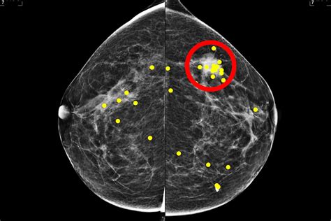 Mammogram Reads Improve When Arranged From Low To High Breast Density