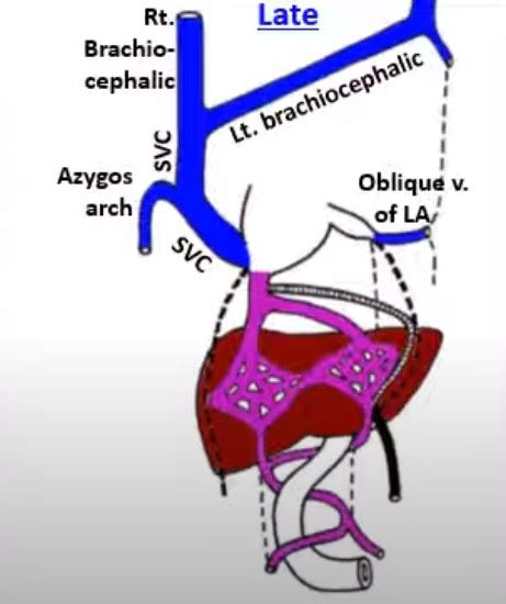 Sinus Venosus Embryology The Common Vein