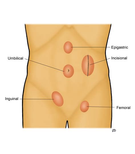 Hernia Surgery Abeezar Sarela
