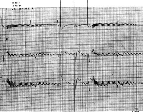 Pacemaker Basics Rebel Em Emergency Medicine Blog