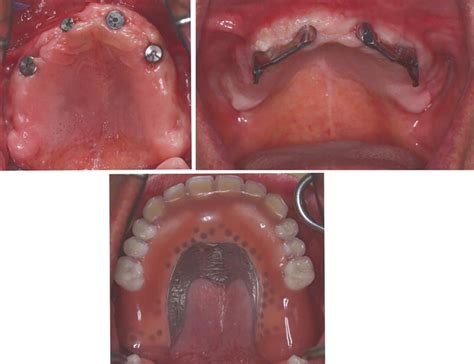 Implant Retained Maxillary And Mandibular Overdentures A Solution For