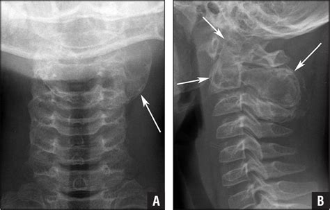 Aneurysmal Bone Cyst Diagnosis And Treatment In Thailand Almurshidi Medical Tourism Best