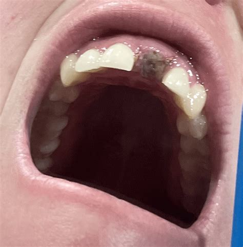 Help Suspected Infection Of Extractionbone Graft Raskdentists