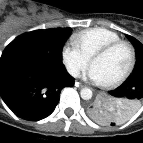 Ct Scan Complete Atelectasis Of The Left Lower Lobe Due To A Blood