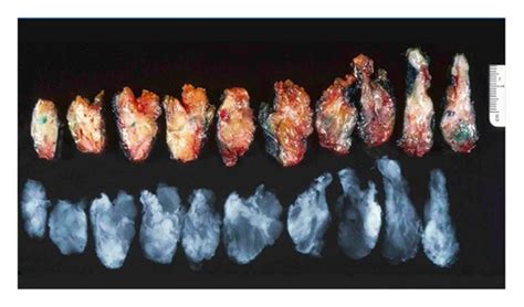 Serially Sectioned Excision Specimen And Its Faxitron X Ray The X Ray