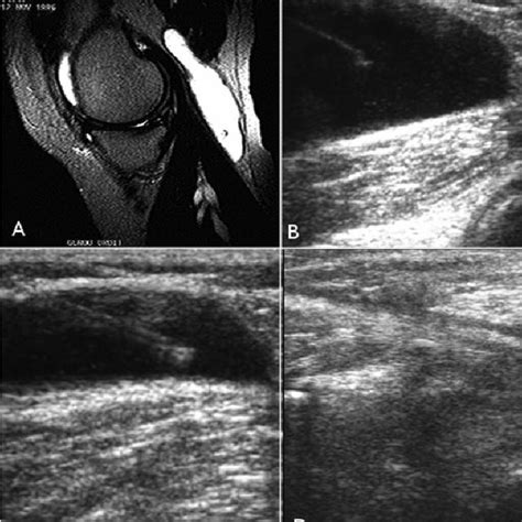 Anterior Approach To Shoulder Arthrogram Performed With The Patient In Download Scientific