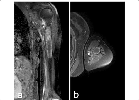 February 2019 Mri Of The Left Humerus After 3 Months Imatinib