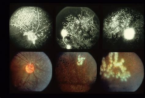 Eales Disease Retina Image Bank