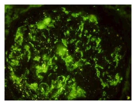 The Light Microscopic Findings And Electron Microscopic Em Findings