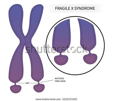 Dna Disorder Testing Fragile X Syndrome Stock Vector Royalty Free 2226331601 Shutterstock