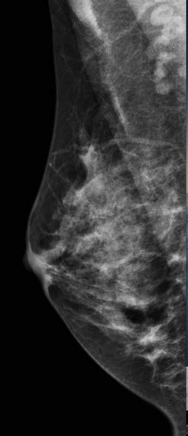 Axillary Lymph Nodes Pacs