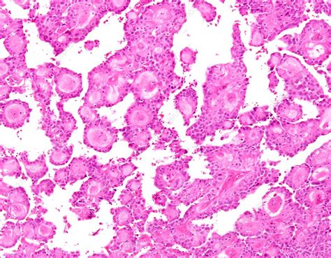 Myxopapillary Ependymoma Light Micrograph Stock Image C0499246