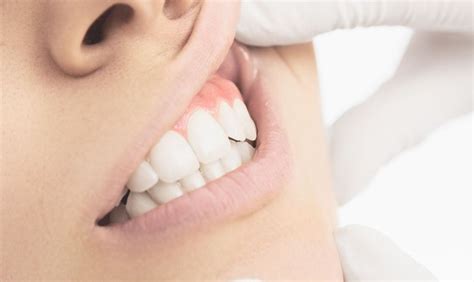 Clear Aligners And Gum Recession All You Need To Know