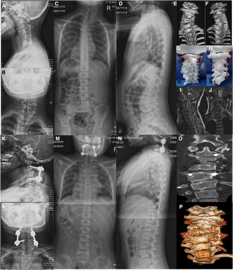 Frontiers A Novel Classification Of Subaxial Cervical Hemivertebrae And Associated Surgical
