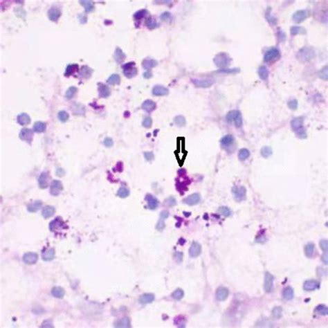 Pathological Examination Of Subcutaneous Nodules Indicate That