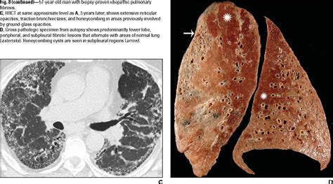Idiopathic Pulmonary Fibrosis Histology