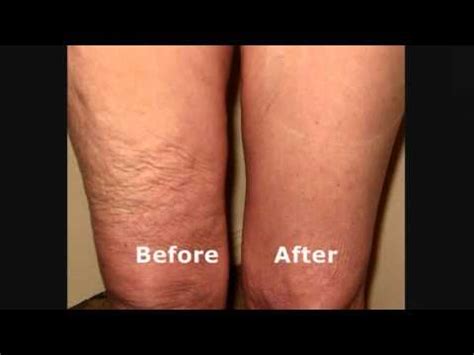 Skinnies Instant Lifts For Thighs Hide Loose Thigh Skin Youtube