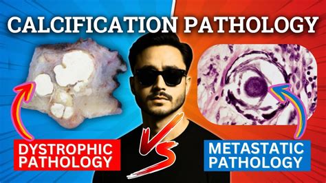 Calcification Pathology Dystrophic And Metastatic Calcification
