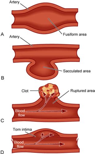 Aortic Aneurysms Flashcards Quizlet