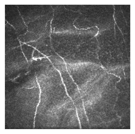 Subbasal Nerve Plexus Images Obtained By Scanning Slit Confocal Download Scientific Diagram
