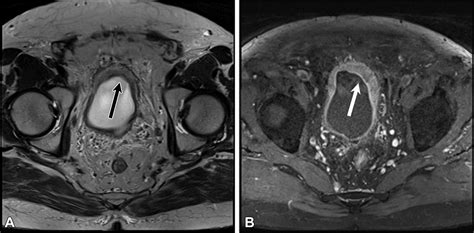 Urinary Bladder Masses Rare Subtypes And Masslike Lesions Radiologic