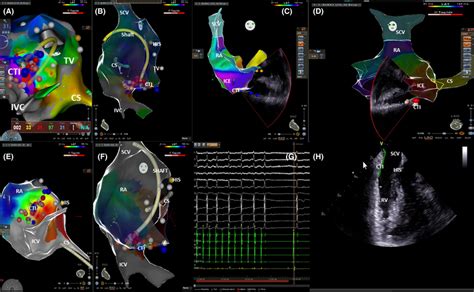 The Ablation Catheter Can Be Entirely Seen From The Tip To The Shaft
