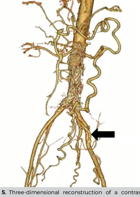 Endovascular Aneurysm Repair With Mesenteric Artery Bypass For An Abdominal Aortic Aneurysm With