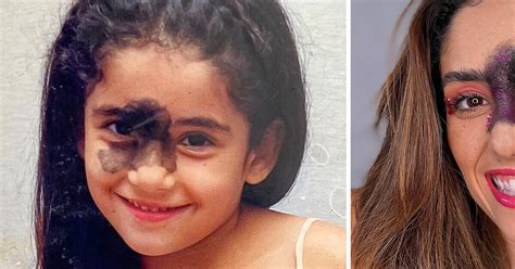 Modelo Brasileira Que Era Chamada De Dálmata” Hoje Dá Um Show De Amor